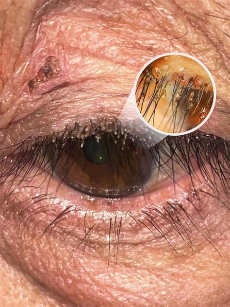 Rận Làm Tổ Trên Mi Mắt đẻ Trứng Chi Chít Cảnh Báo Về Nguy Cơ Nhiễm