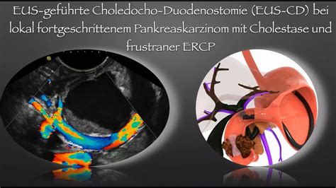 Eus Geführte Choledocho Duodenostomie Eus Cd Youtube