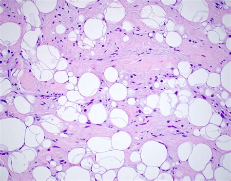 Spindle Cell Lesion Pathology Outlines At Jon Lefebre Blog