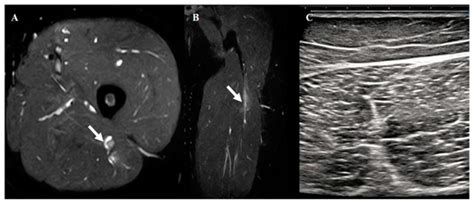 Role Of Ultrasonography And Mri In Acute Hamstring Strains Diagnostic