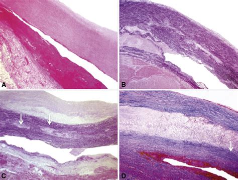 A And B Aortic Dissection Samples From Pure Degenerative Cases A A Download Scientific