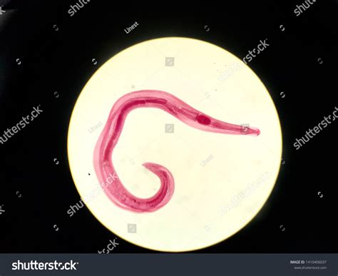 Enterobius Vermicularis Slide Pinworm Enterobiasis Workup Approach