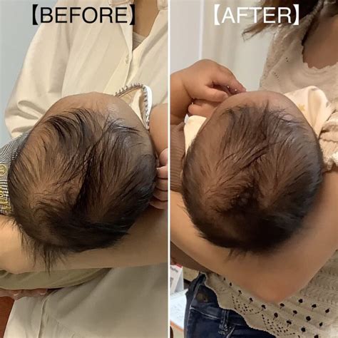 絶壁頭の整体｜赤ちゃんの短頭症の治し方を大阪の整体サロンinuiが解説 整体サロンinui
