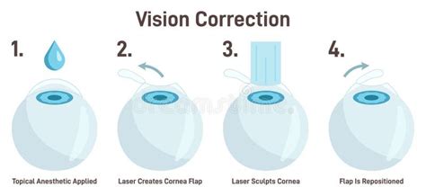 Vision Correction Laser Eye Surgery Ophthalmology Procedure Stock