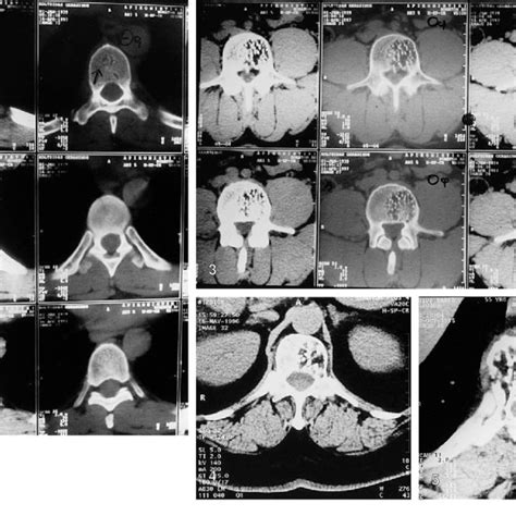 Harrington Luque Instrumentation T10 L4 Download Scientific Diagram