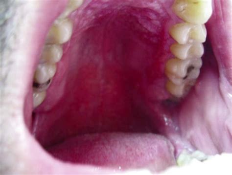 Mucosal Patch Of Fixed Erythema Download Scientific Diagram