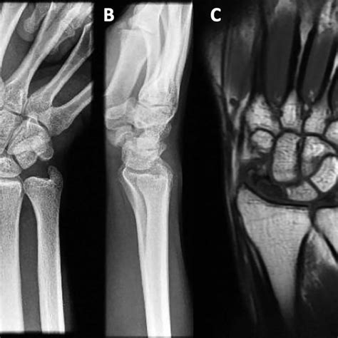 Scaphoid Reconstruction A Volar Scaphoid Approach To Expose Bone