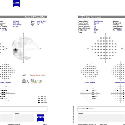Humphrey 24 2 Visual Field Illustrating Enlarged Blind Spots With