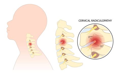 Cervical Radiculopathy Symptoms Diagnosis And Treatments