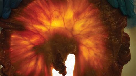 Mesenteric Vascularized Lymph Node Transfer Clinical Tree