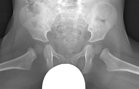 X Ray Lead Shielding Thickness At Danny Garza Blog