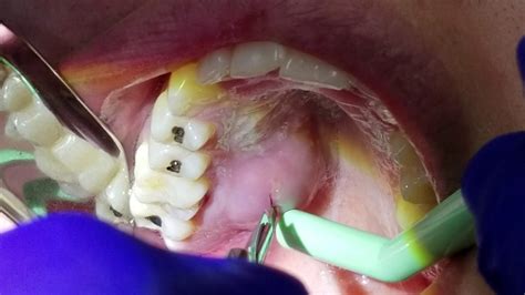 Tooth Abscess Drainage