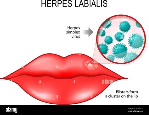 Herpes Simplex Labialis Virus