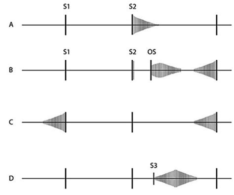 The Diastolic Murmurs Indian Journal Of Cardiovascular Disease In Women
