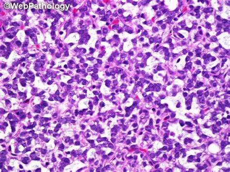 Myxoid Liposarcoma High Grade