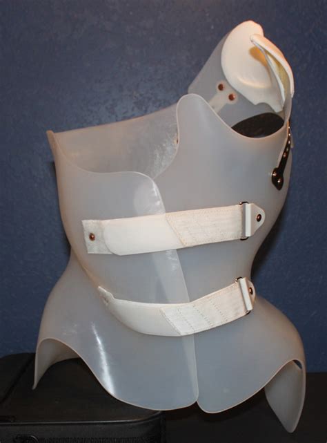 The Schroth Method A Conservative Non Surgical Treatment Option For