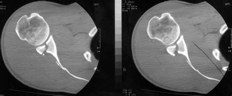 Ct Scan Showing A Large Glenoid Fracture Download Scientific Diagram