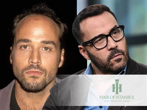 Jeremy Piven Hair Transplant Before And After