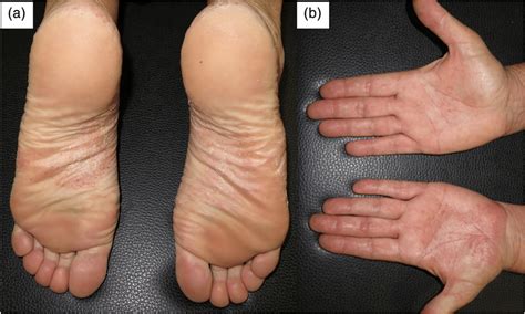 Multiple Creamy‐white Pustules On An Erythematous And Desquamative