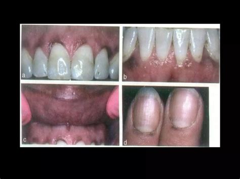 Gingival Pigmentation Ppt