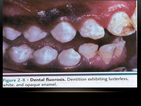 Lab 3 Developmental Defect Teeth Dina Pptx