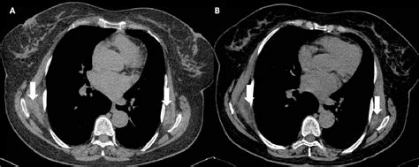Figure 6 From Elastofibroma Dorsi 30 Lesions In 16 Patients With Ct And Mri Findings Semantic