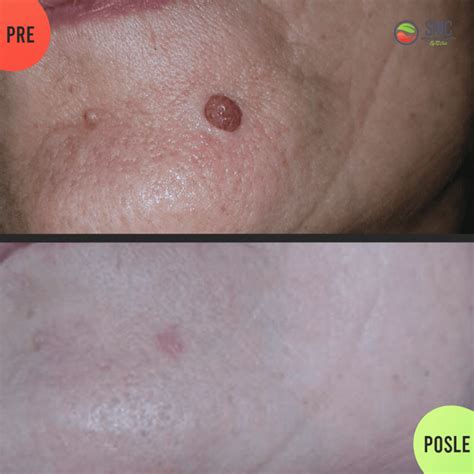 Uklanjanje Mladeža Radiotalasnom Metodom