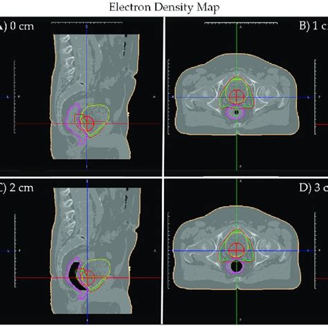 Patient As Planning Ct Electron Density Maps With Artificial Tubular