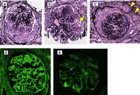 Pathological Findings On Light Microscopy And Immunofluorescence