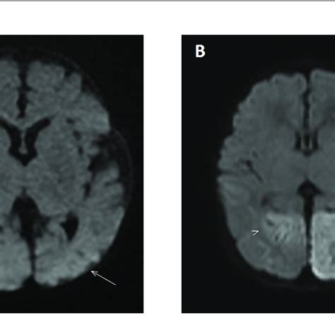 A Diffusion Weighted Mri On Day 4 Of Life Showing Increased Signal
