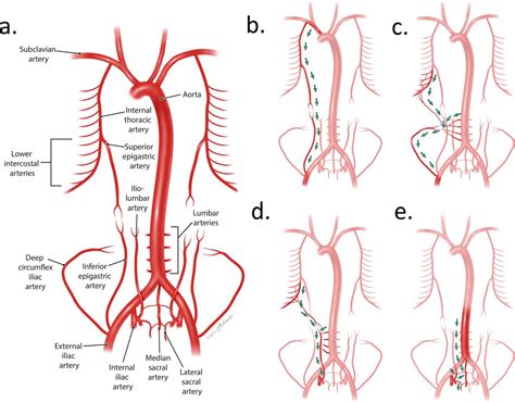 Inferior Epigastric Artery Anatomy