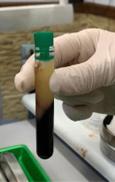 Injectable Platelet Rich Fibrin I Prf Download Scientific Diagram