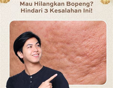 Mau Hilangkan Bopeng Jangan Sampai Salah Langkah Insta Beauty Center