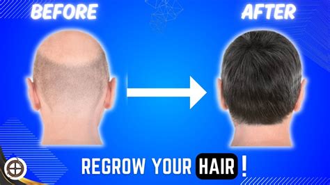 10 Natural Hair Treatment Tips To Regrow Your Hairs After Hair Loss