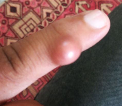 Osteophyte Of Figure Medizzy