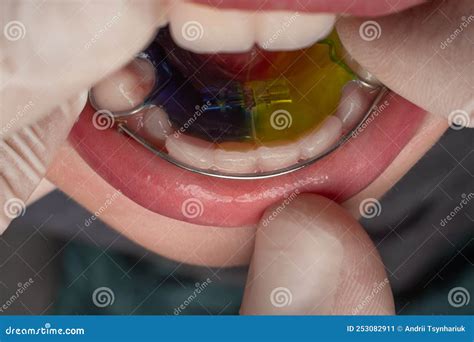 Placa Para Os Dentes Inferiores Ortodontia E Placa Para Os Dentes Da