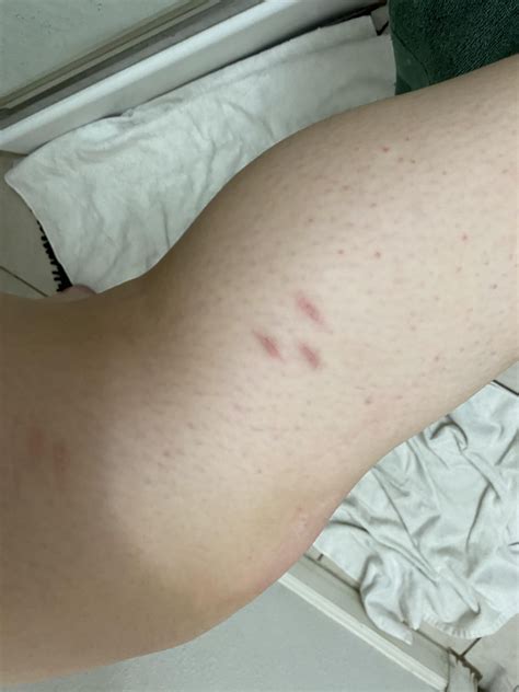What Story Can I Make Up For These Small Sh Scars On Upper Calf Rscars