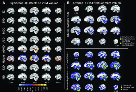 Polygenic Risk Score Prs Effects On Voxel Based Morphometry Vbm