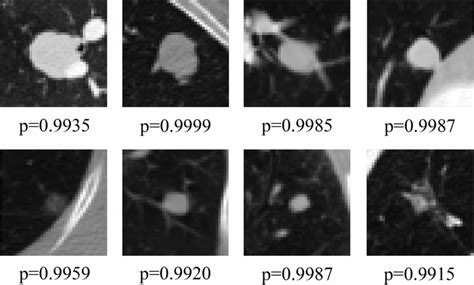 Examples Of Pulmonary Nodule Detection Results Of Our Framework Each Download Scientific