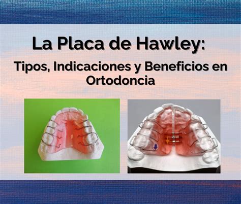 La Placa De Hawley Tipos Indicaciones Y Beneficios En Ortodoncia