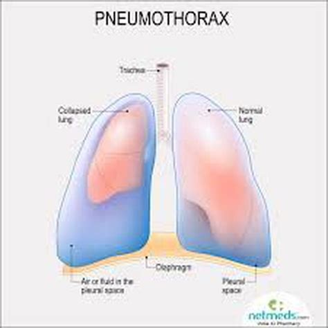 Treatment For Pneumothorax Medizzy