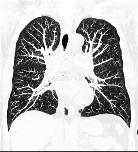 Ct Chest Scan Overview Shows Clear Lung Fields Heart And Mediastinum