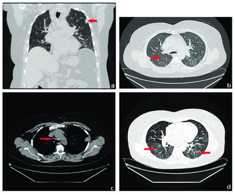 A Chest Ct Was Performed Which Revealed Subpleural Micronodular And Download Scientific
