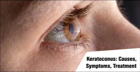 Keratoconus Causes Symptoms Treatment Skipper Eyeq