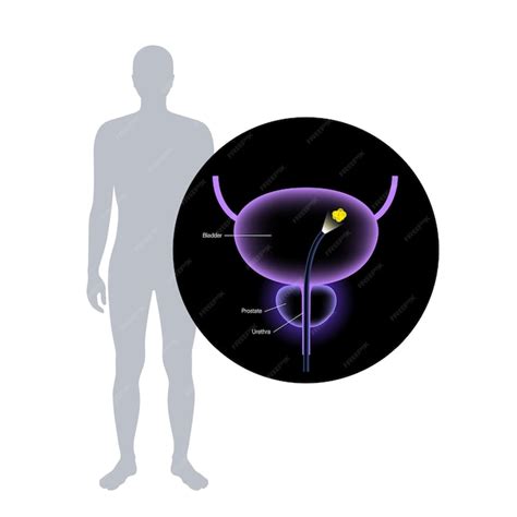 Premium Vector Cystoscopy Is A Minimally Invasive Procedure Examination And Treatment Of The