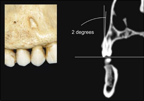 Bucco Lingual Inclination Of A Maxillary First Premolar With A Download Scientific Diagram