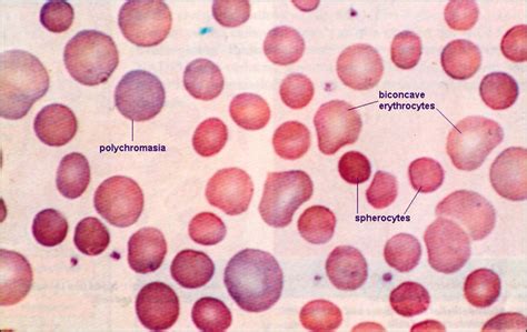 Pediatrics Notes Laboratory Finding In Hereditary Spherocytosis