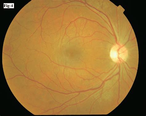 Fundus Photograph Showing Complete Resolution Of Optic Nerve Head Edema