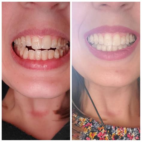 Permanent Retainers Yes Or No R Invisalign