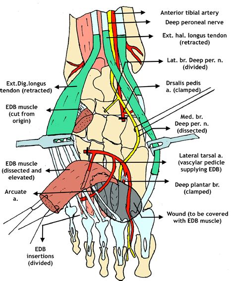 The Reverse Flow Extensor Digitorum Brevis Flap For Dorsal Foot Defects